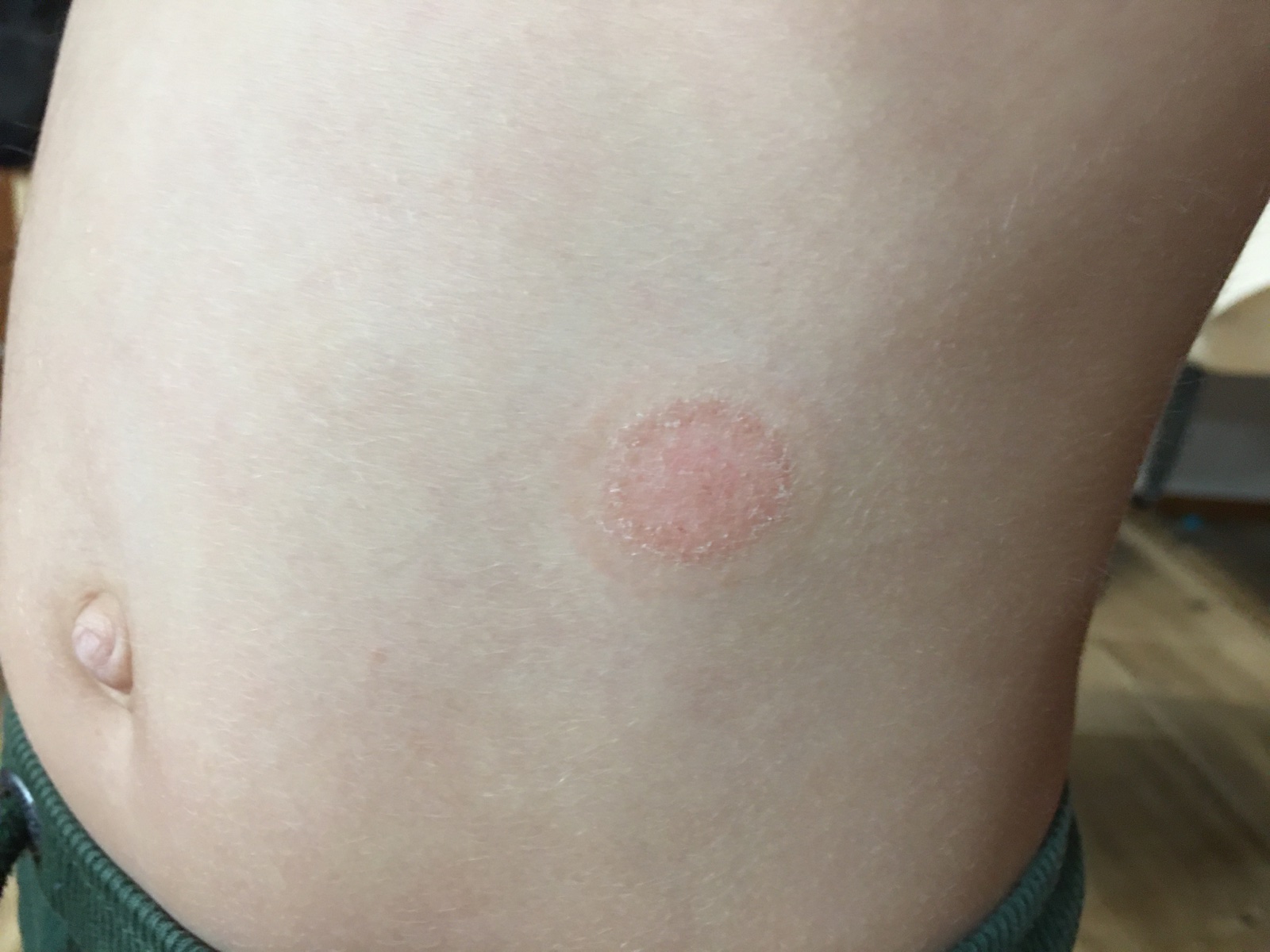 [Zodpovězené] Flek na břiše. O co by se mohlo jednat? - Modrý koník