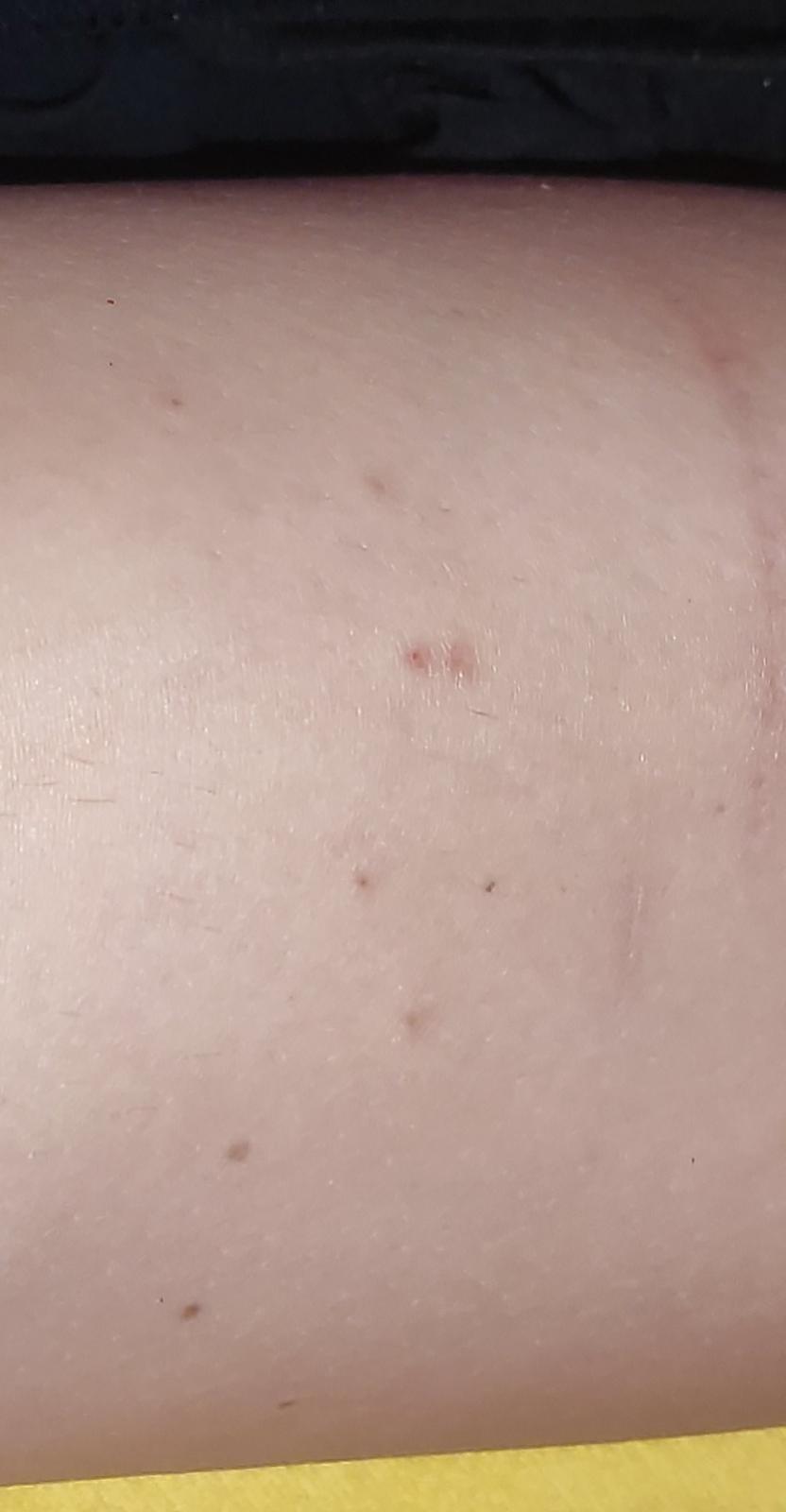 Zahadna vyrážka/ štipance - Modrý koník