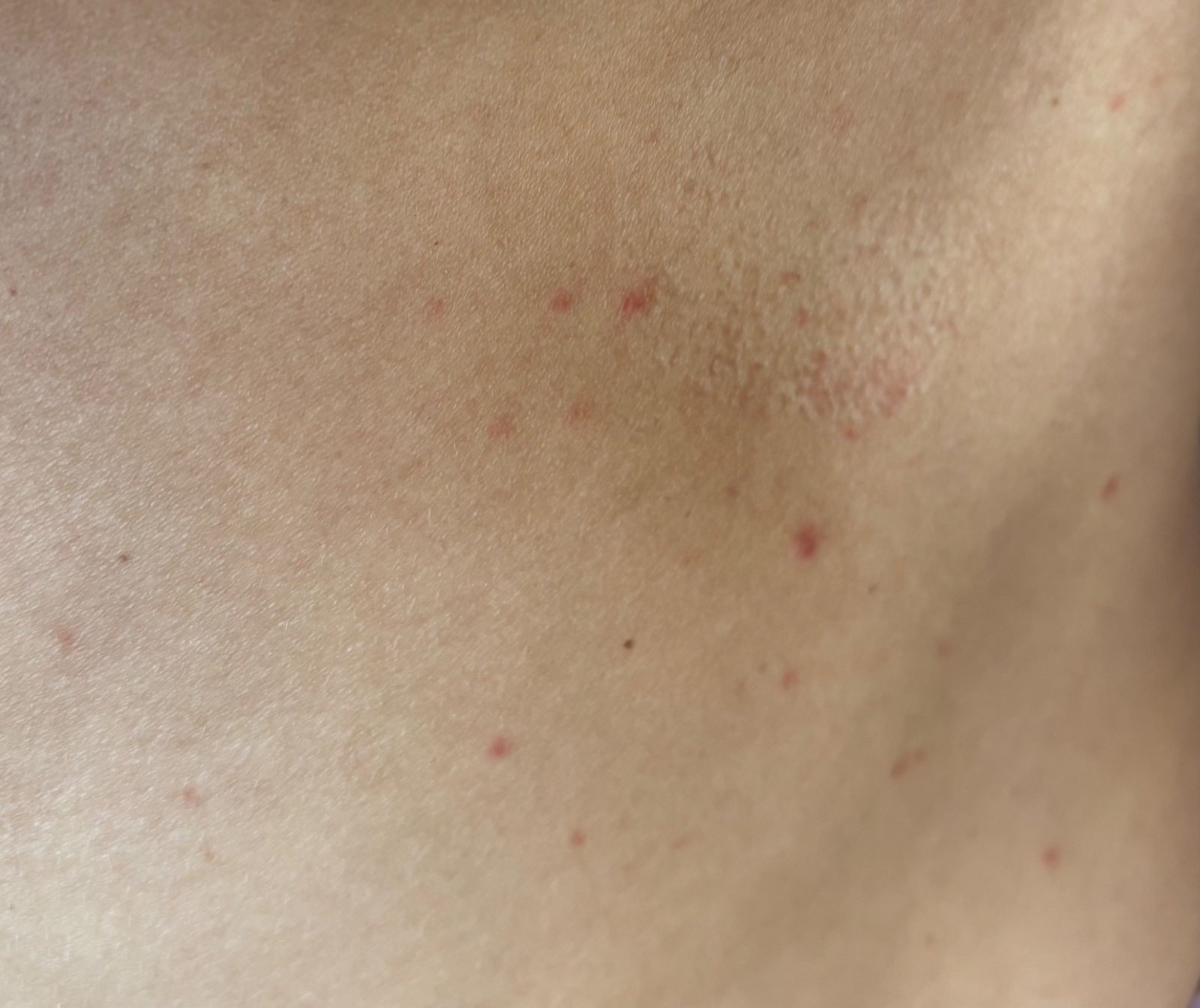 Červené fleky na těle. Co to může být? - Modrý koník