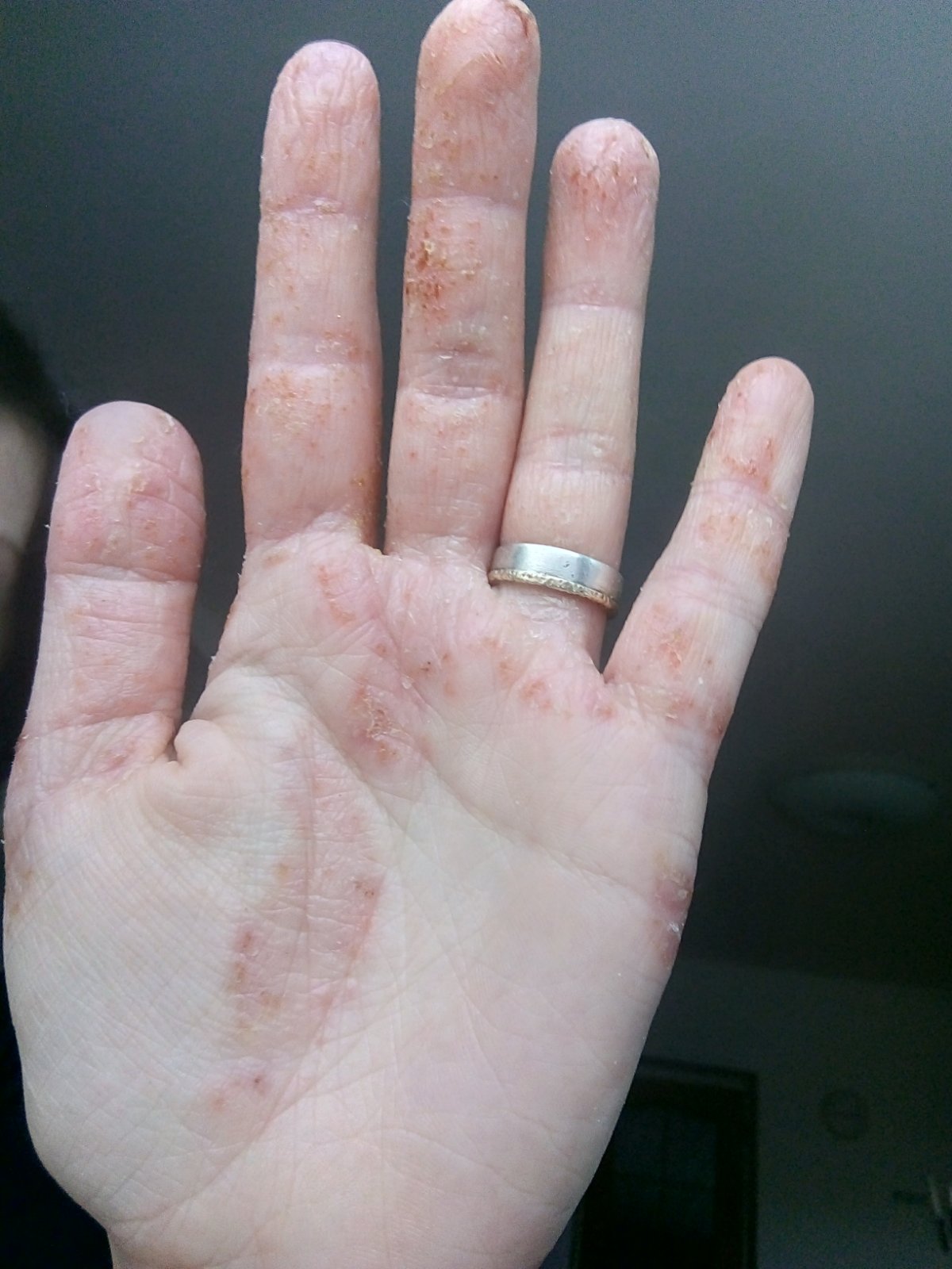 [Zodpovězené] Jak vhodně léčit ekzém na rukou po porodu? - Modrý koník