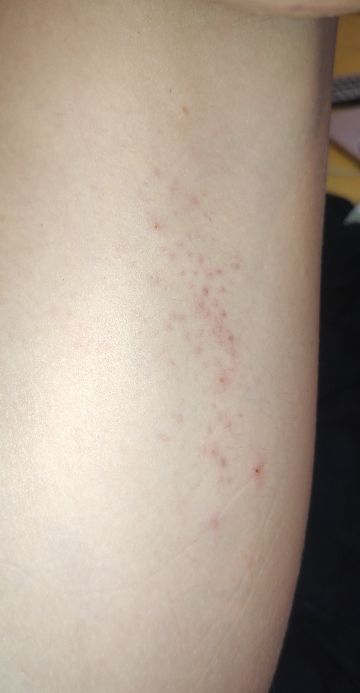 Zahadna vyrážka/ štipance - Modrý koník