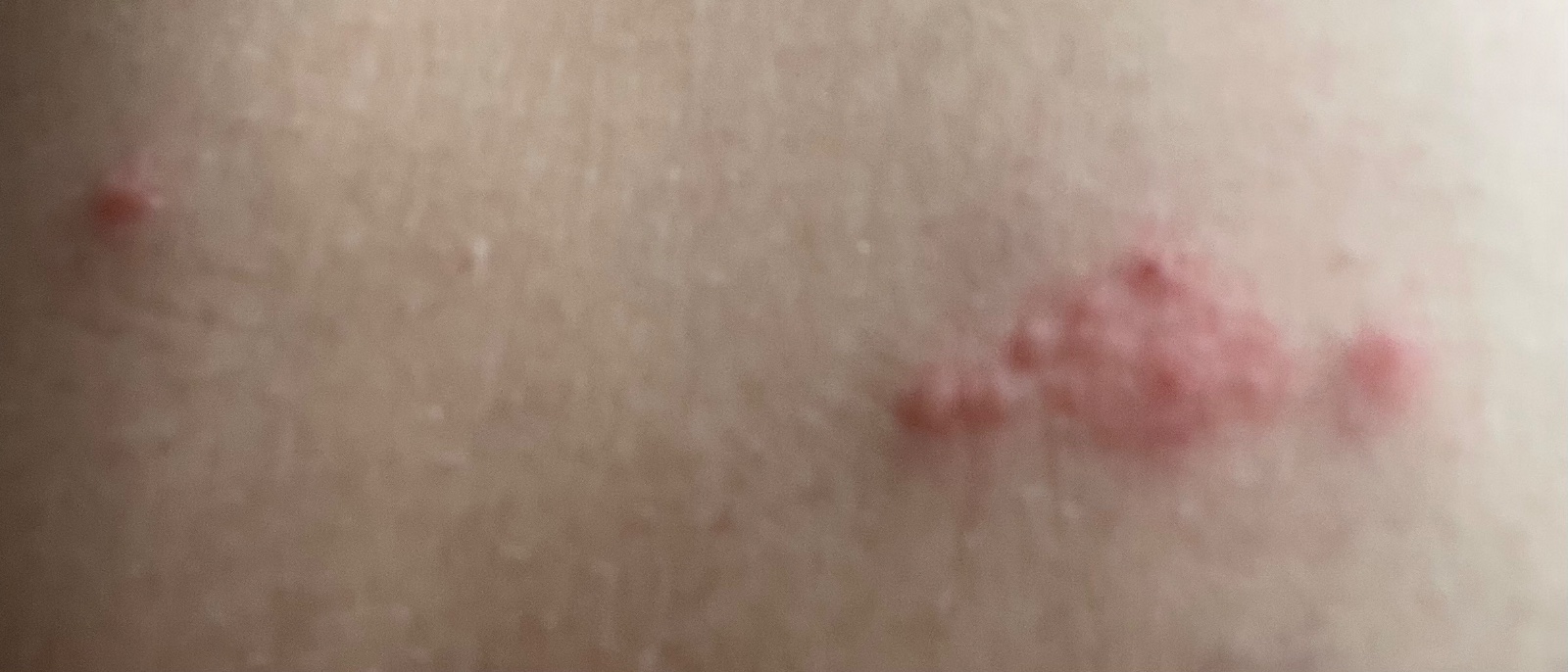 Jsou svědivé štípance na noze od štěnic? - Modrý koník