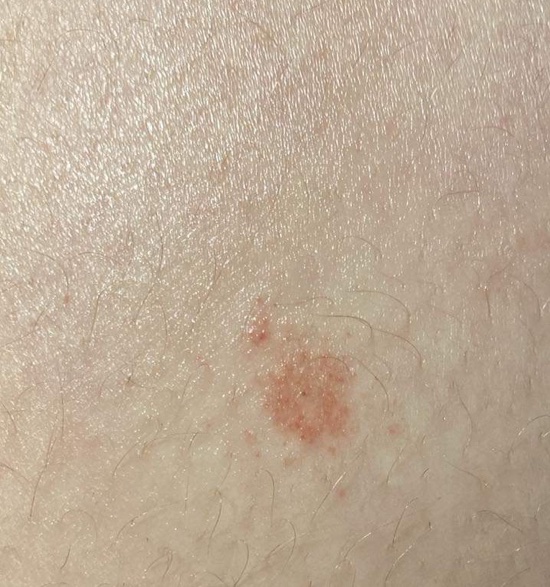 Nesvědivé červené fleky. Co to může být? - Modrý koník