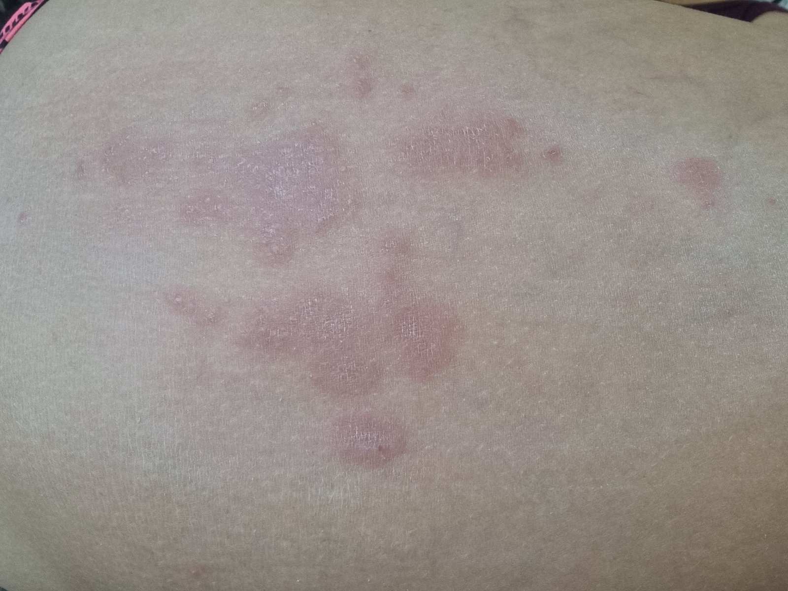 Kožní infekce, plíseň z Tunisu? - Modrý koník