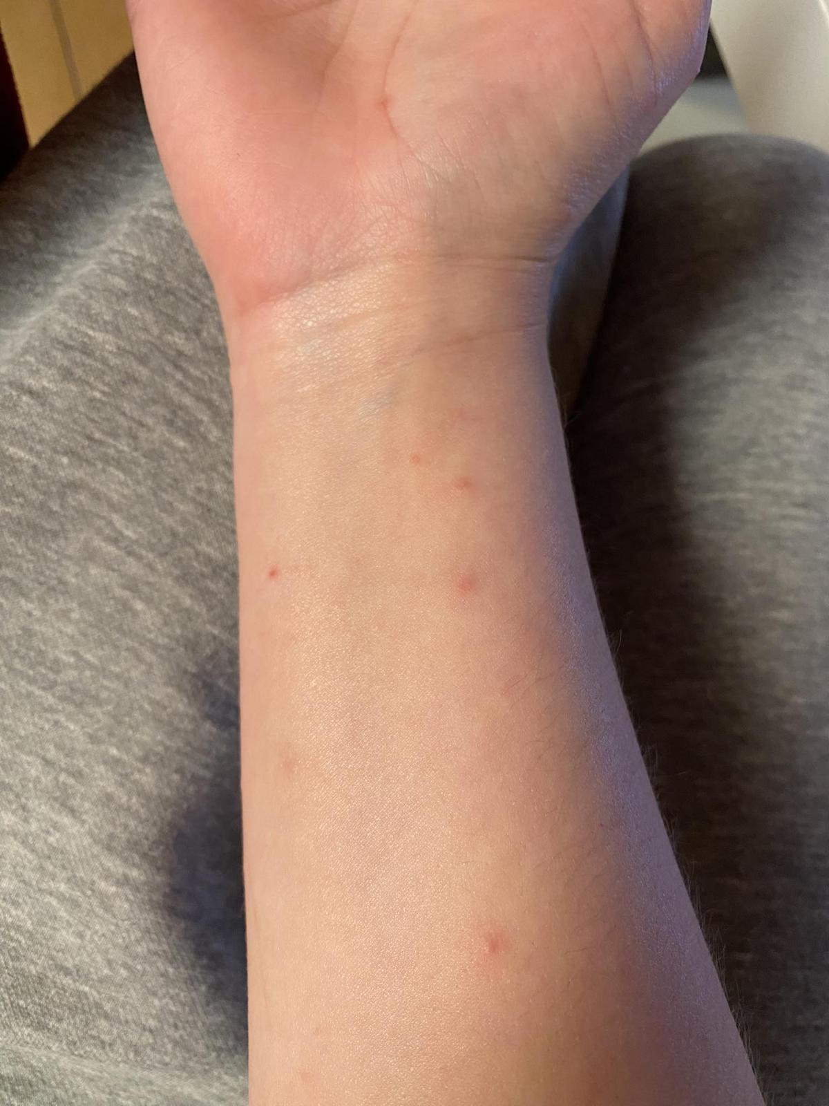 Alergie nebo svrab? - Modrý koník