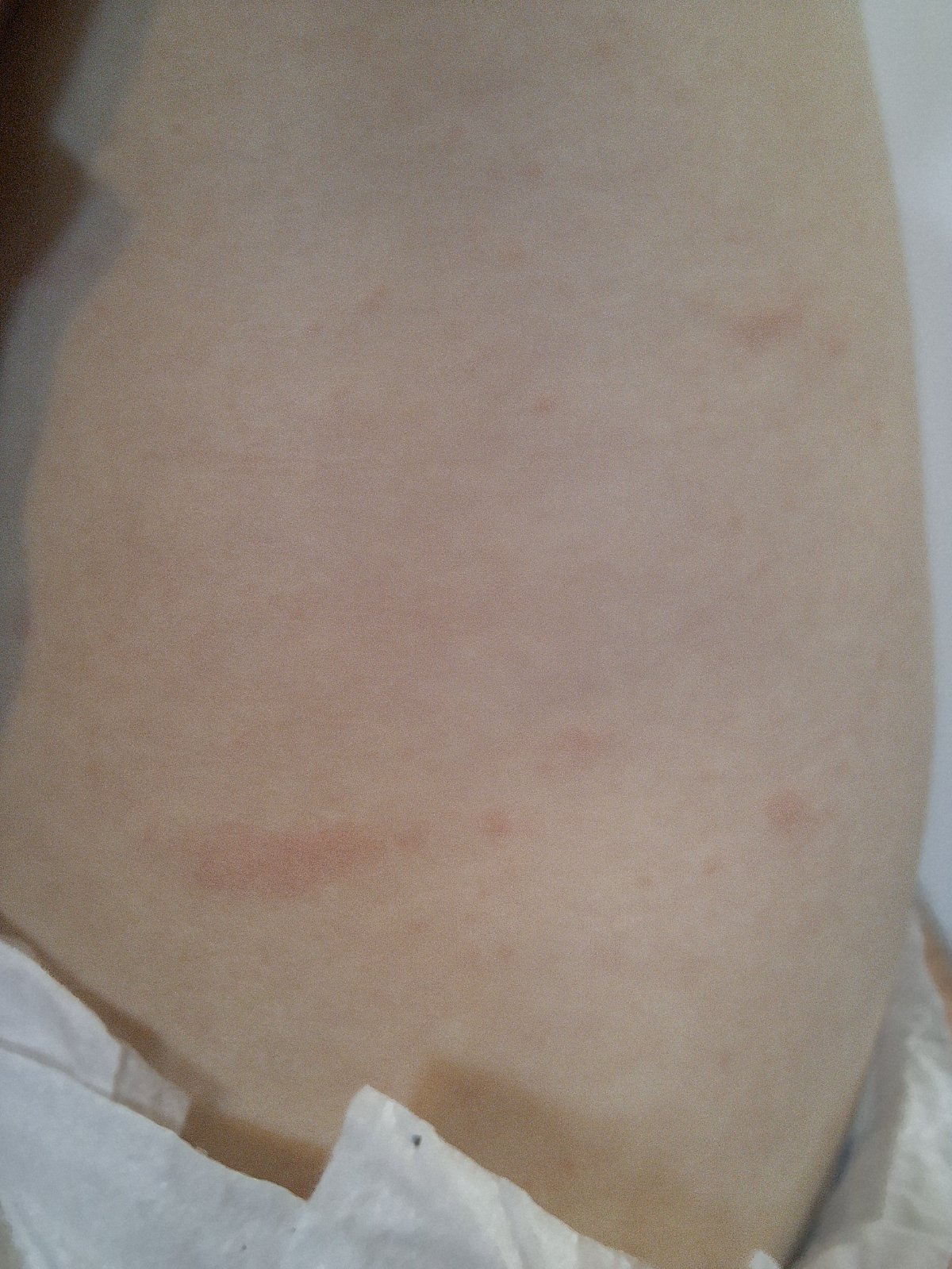 Pupínky u ročního syna. Jsou to štípance? - Modrý koník