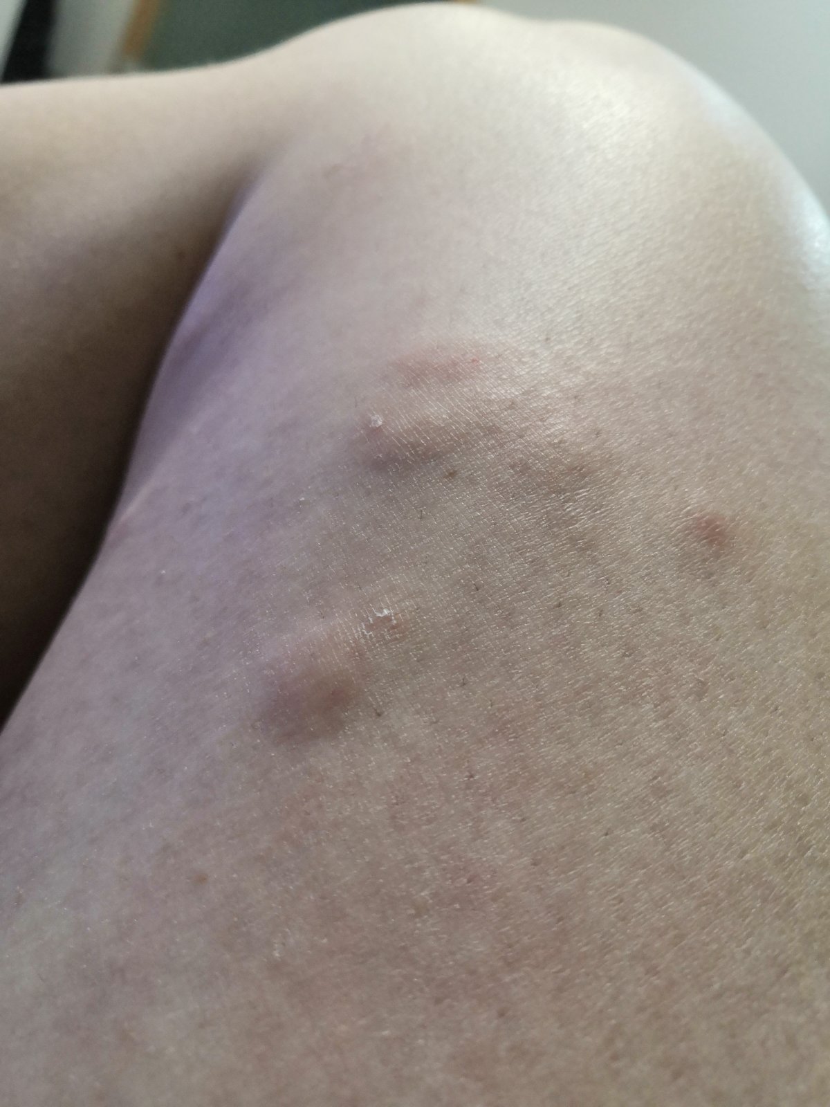 [Zodpovězené] Červené fleky na nohách. O co by se mohlo jednat? - Modrý koník