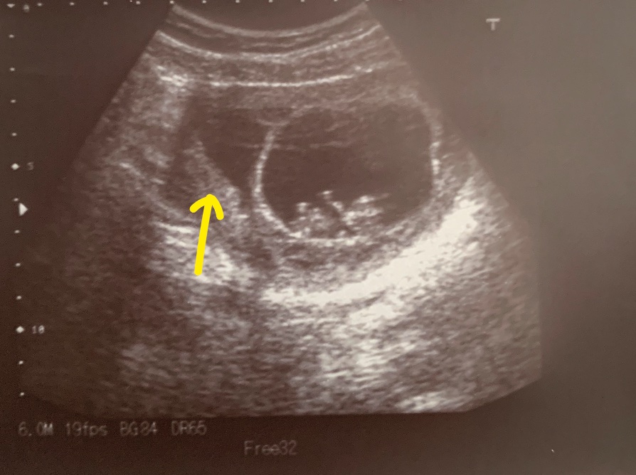 Zkušenosti s hematomem v těhotenství bez krvácení - Modrý koník