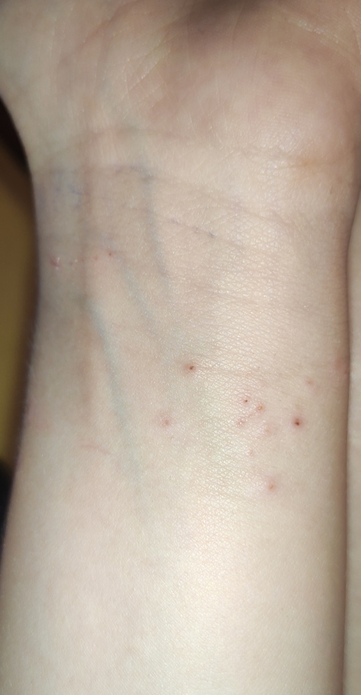 Zahadna vyrážka/ štipance - Modrý koník